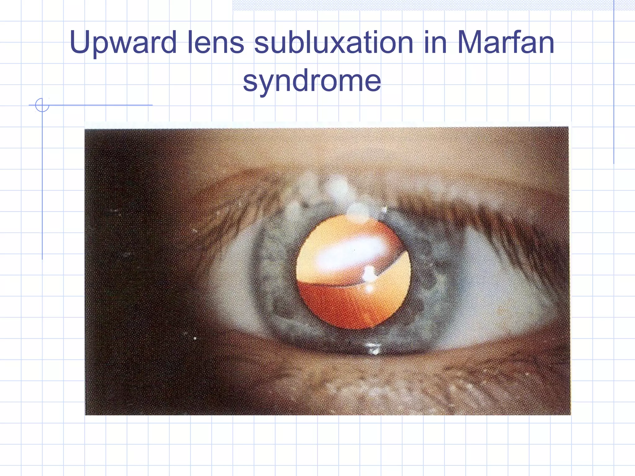 Congenital defects of the lens | PPT
