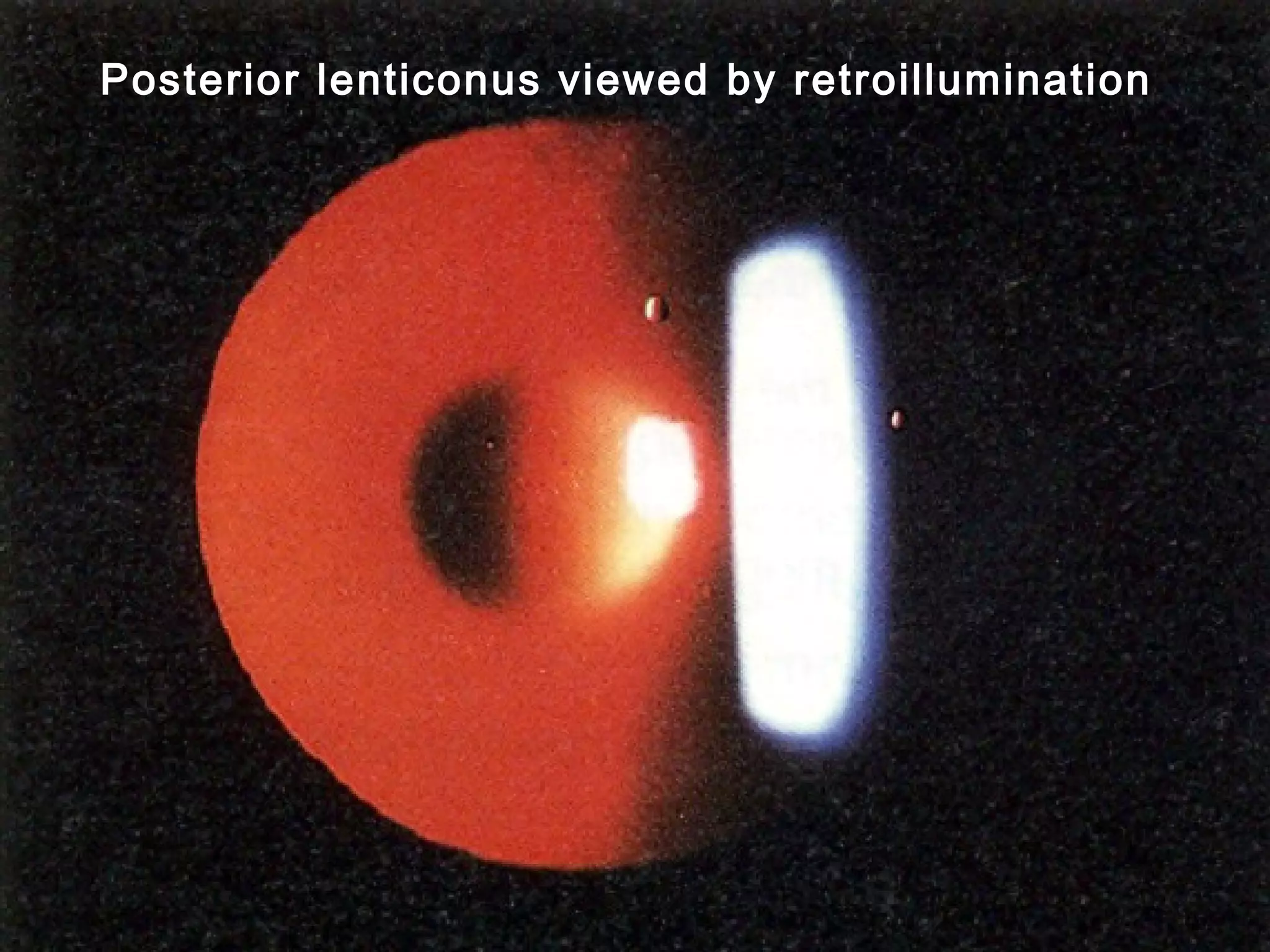 Congenital defects of the lens | PPT