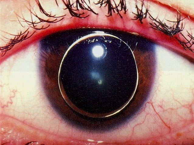 Congenital defects of the lens | PPT