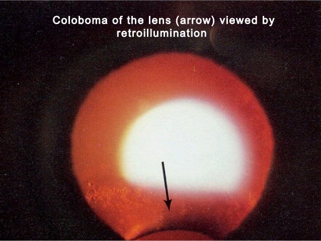 Congenital defects of the lens
