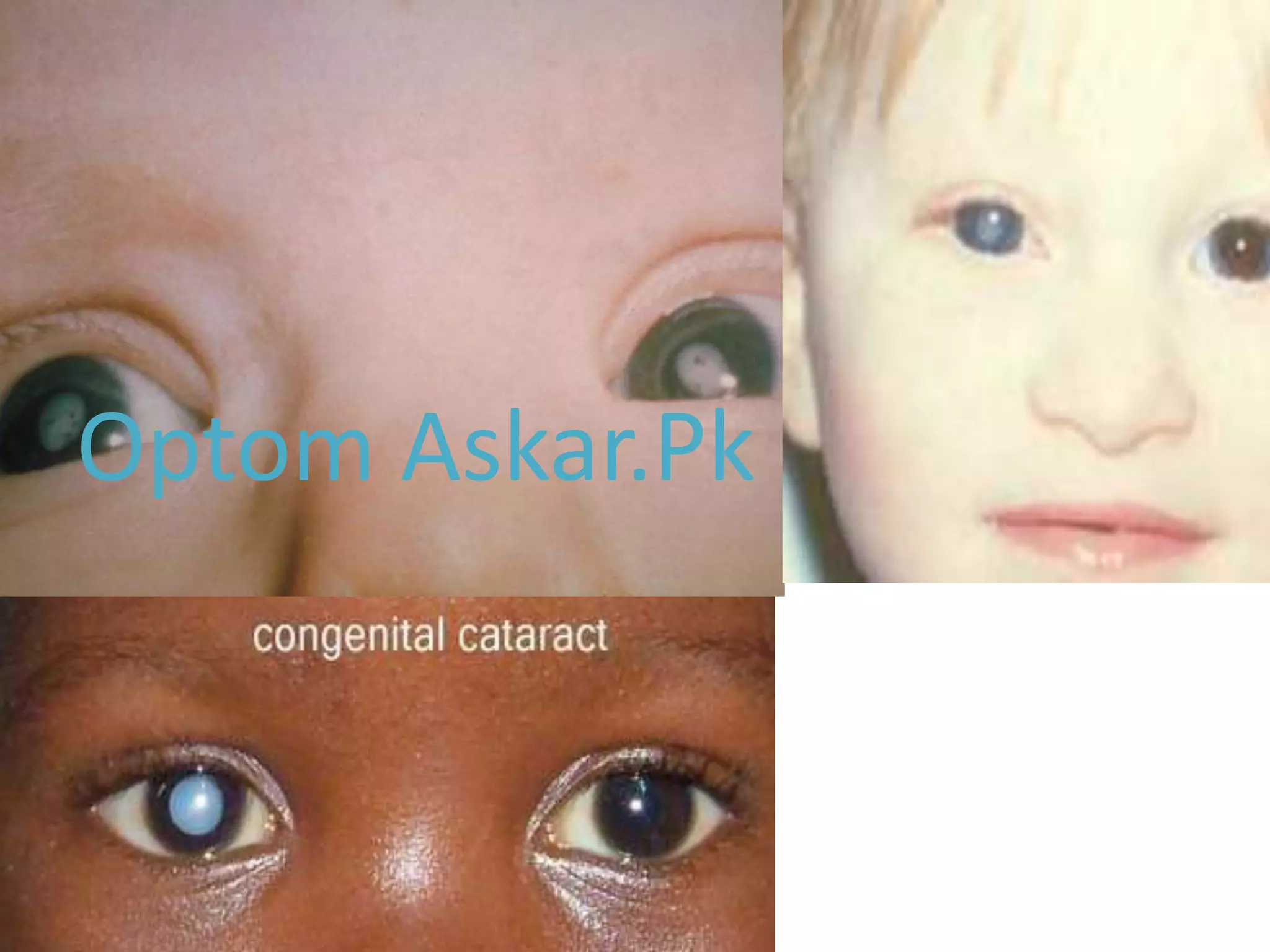 Congenital cataract | PPT