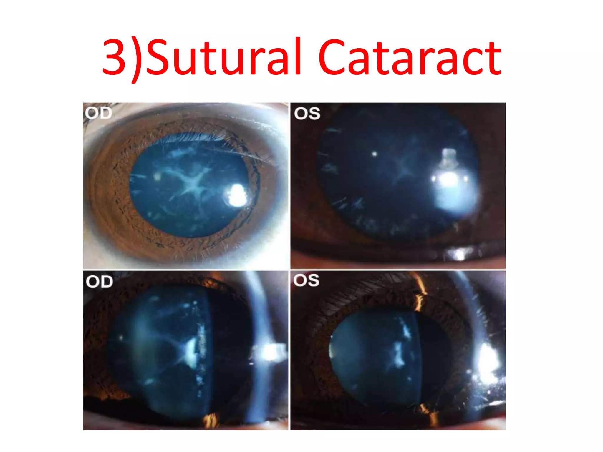 Congenital cataract | PPT