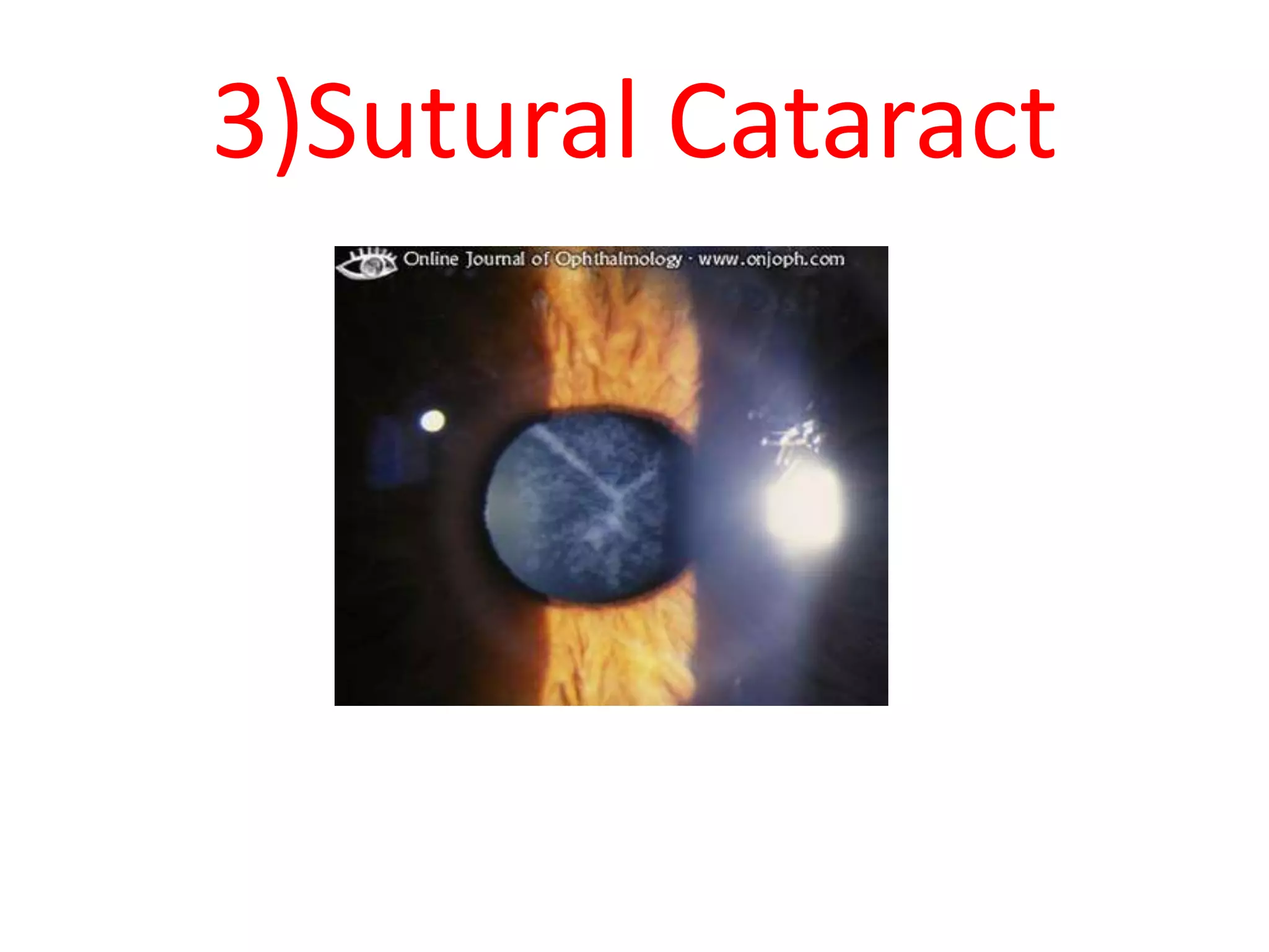 Congenital cataract | PPT