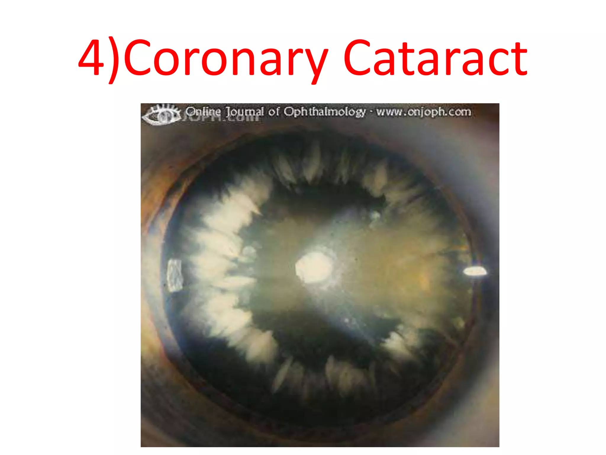 Congenital cataract | PPT