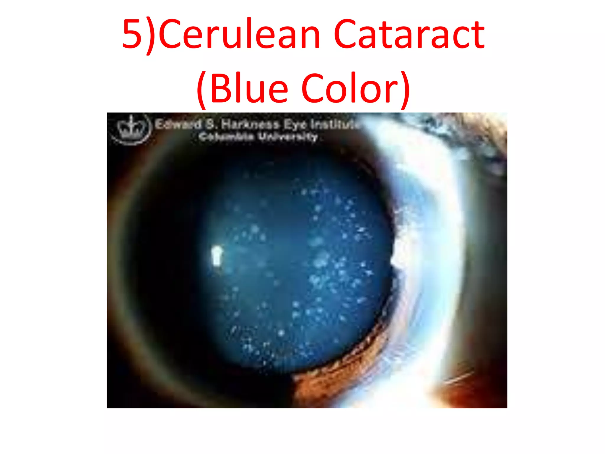 Congenital cataract | PPT