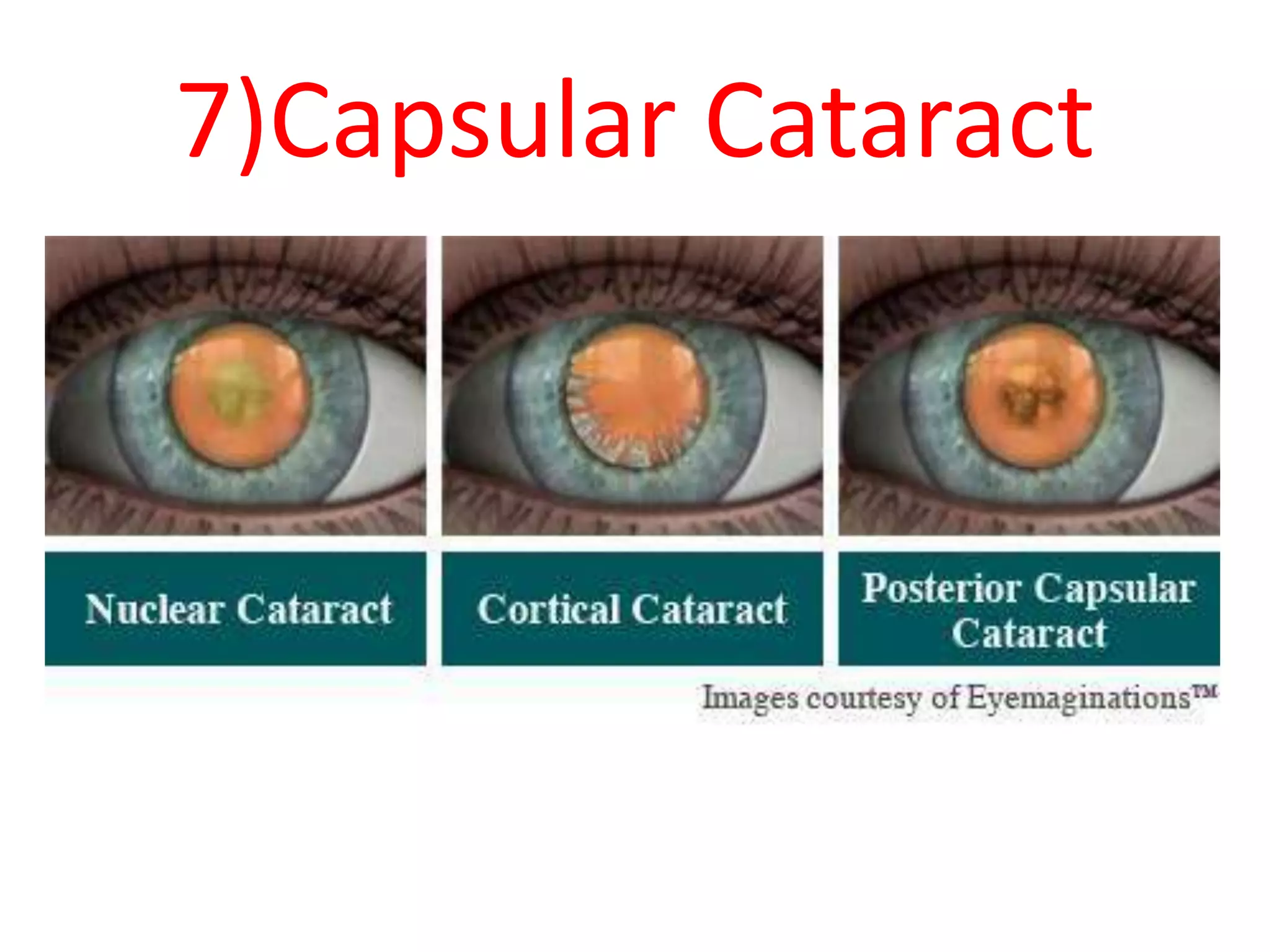 Congenital cataract | PPT