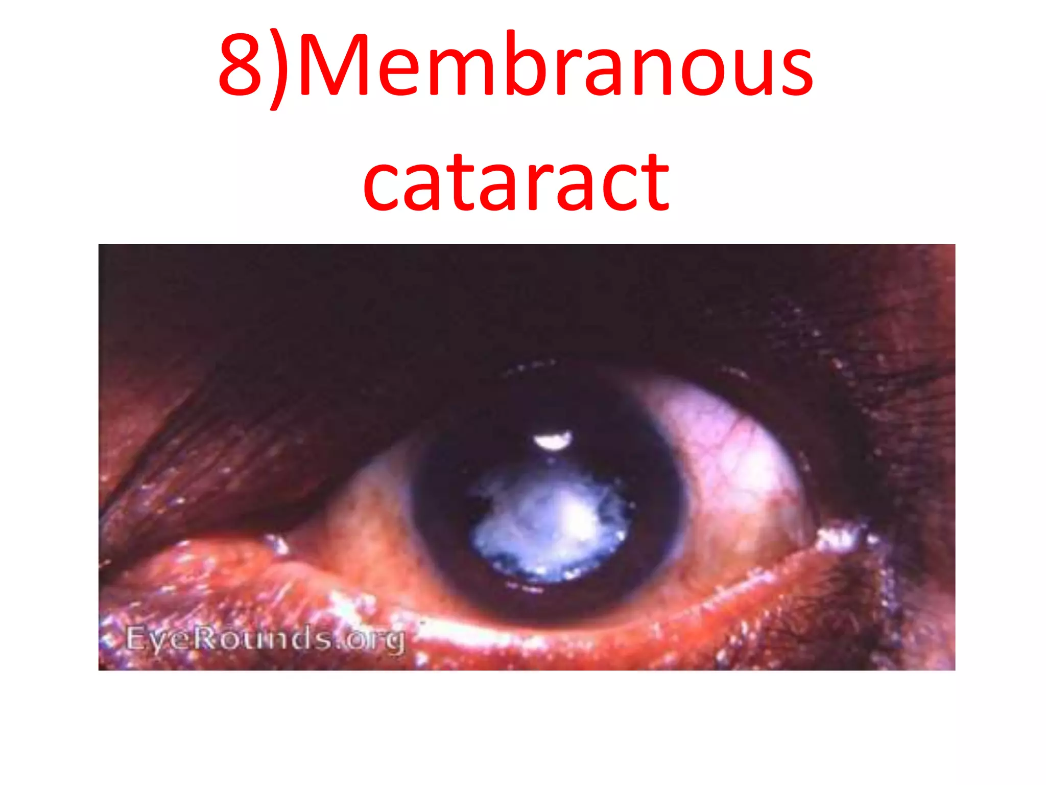 Congenital cataract | PPT