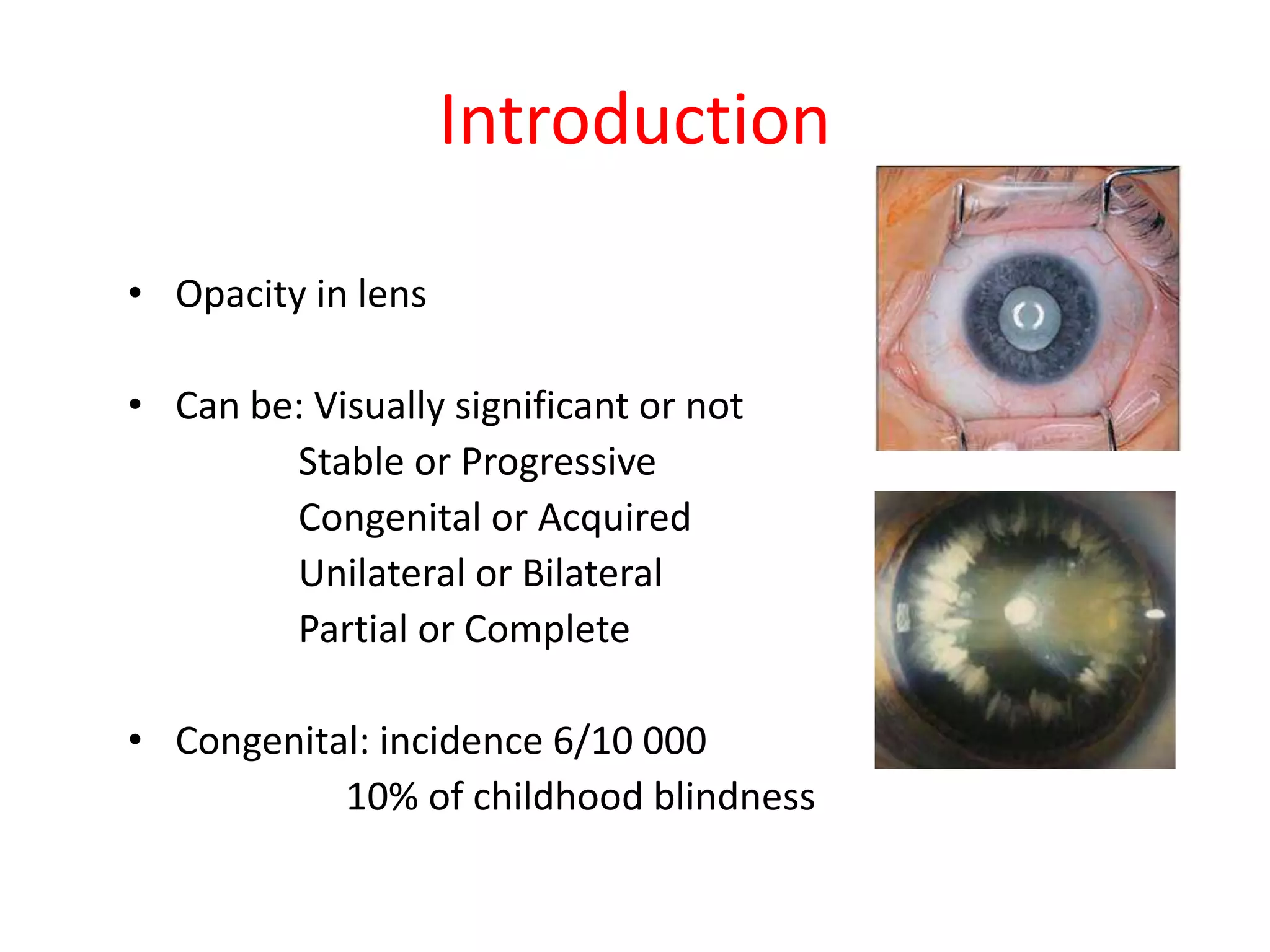 Congenital cataract | PPT