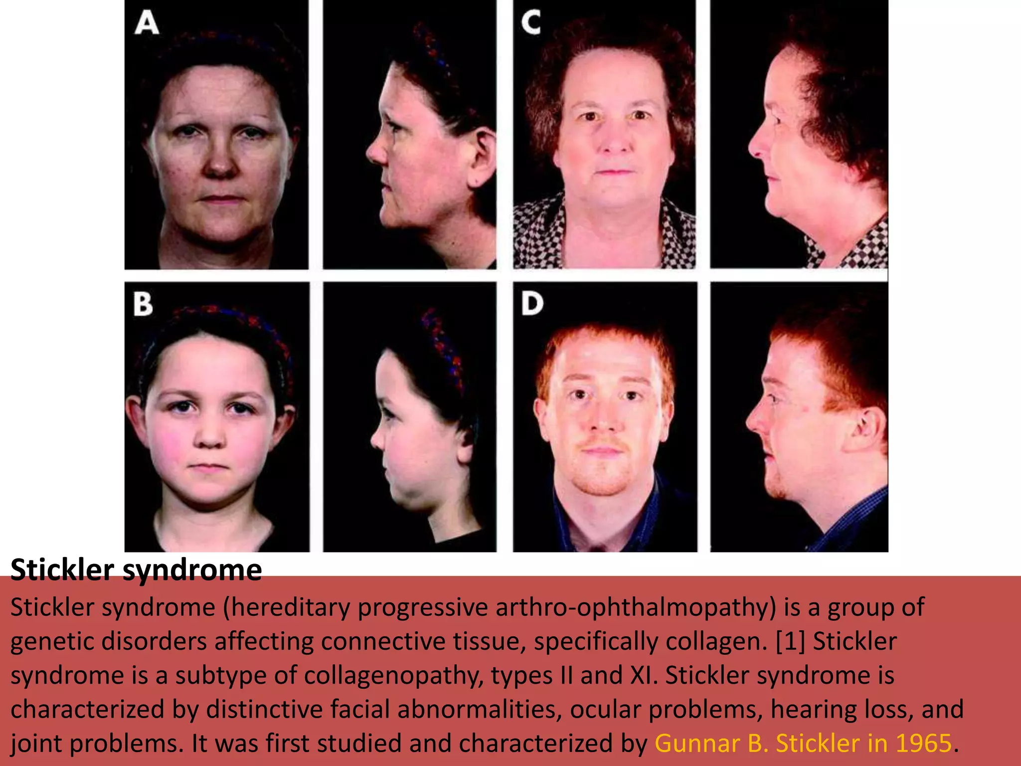 Congenital cataract | PPT