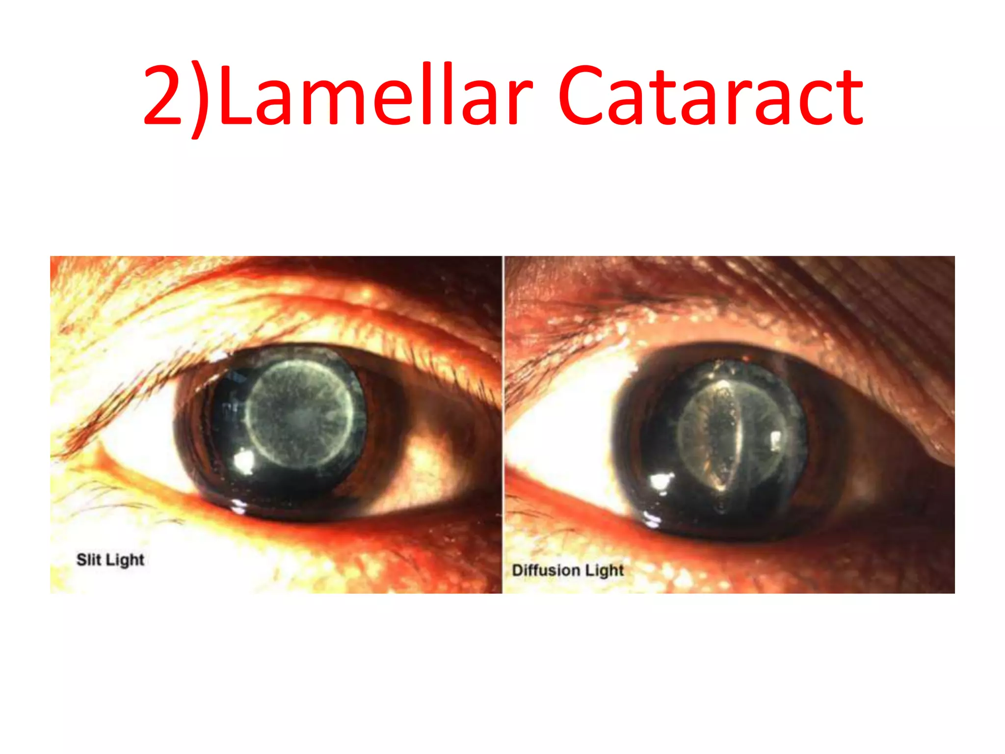 Congenital cataract | PPT