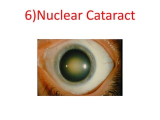 Congenital cataract | PPT