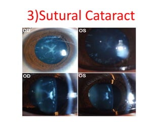 Sutural Cataract