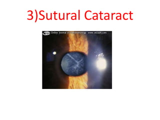 Sutural Cataract
