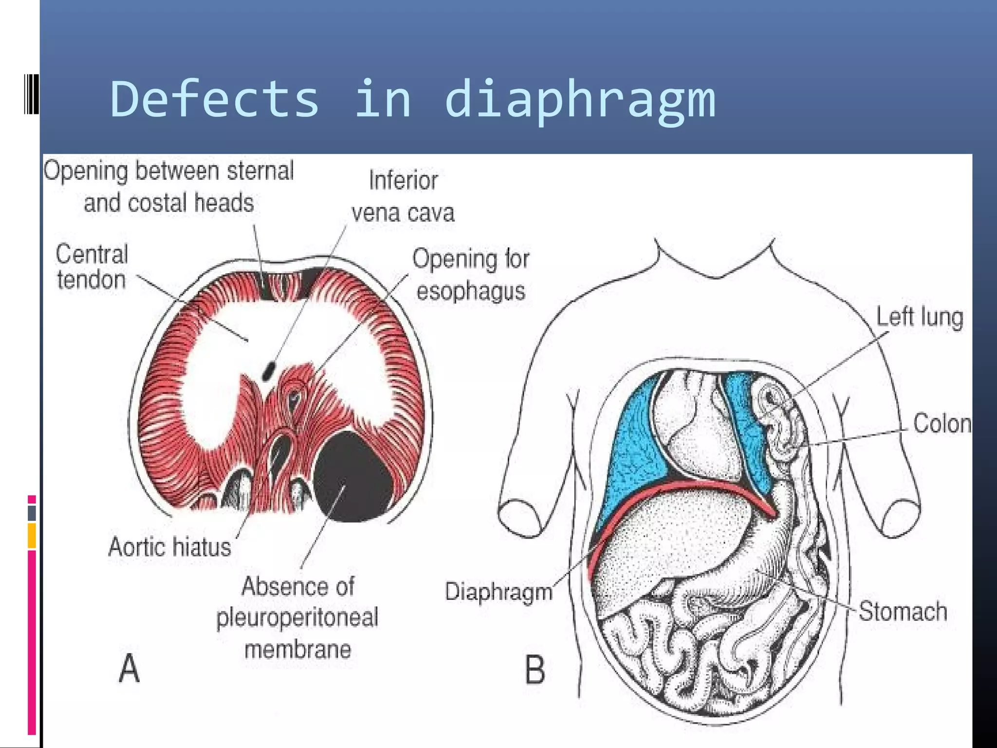 anaesthetic implications of Congenital diaphragmatic-hernia | PPT