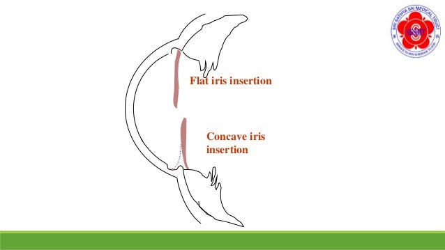 Congenital glaucomas