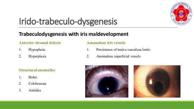 Congenital glaucomas