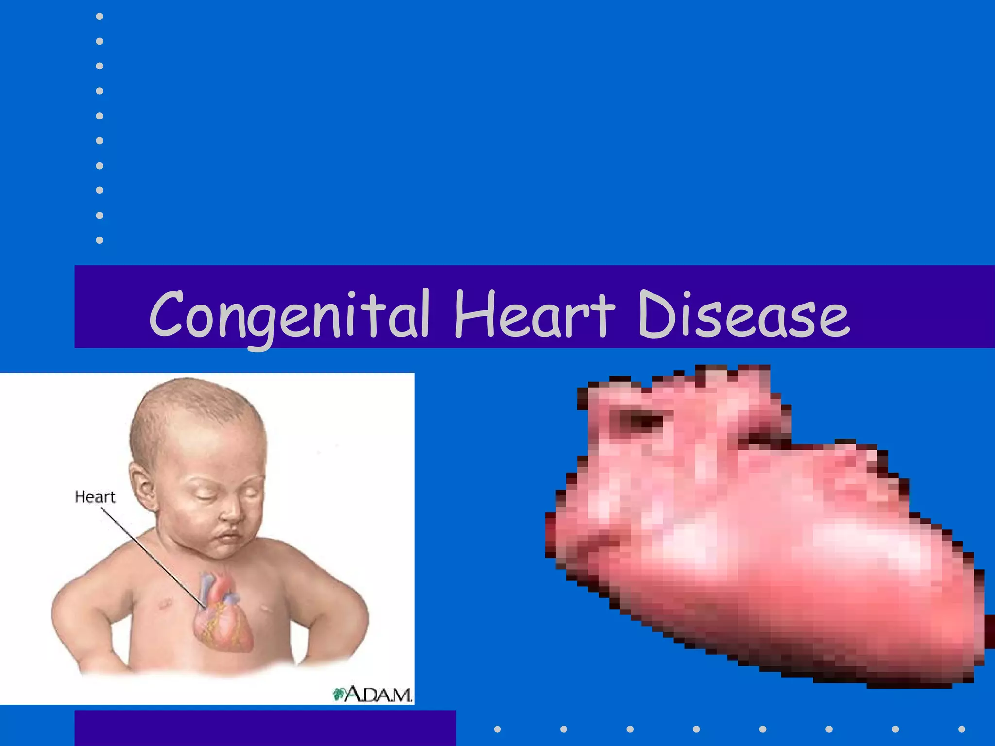 Congenital Heart Disease | PPT