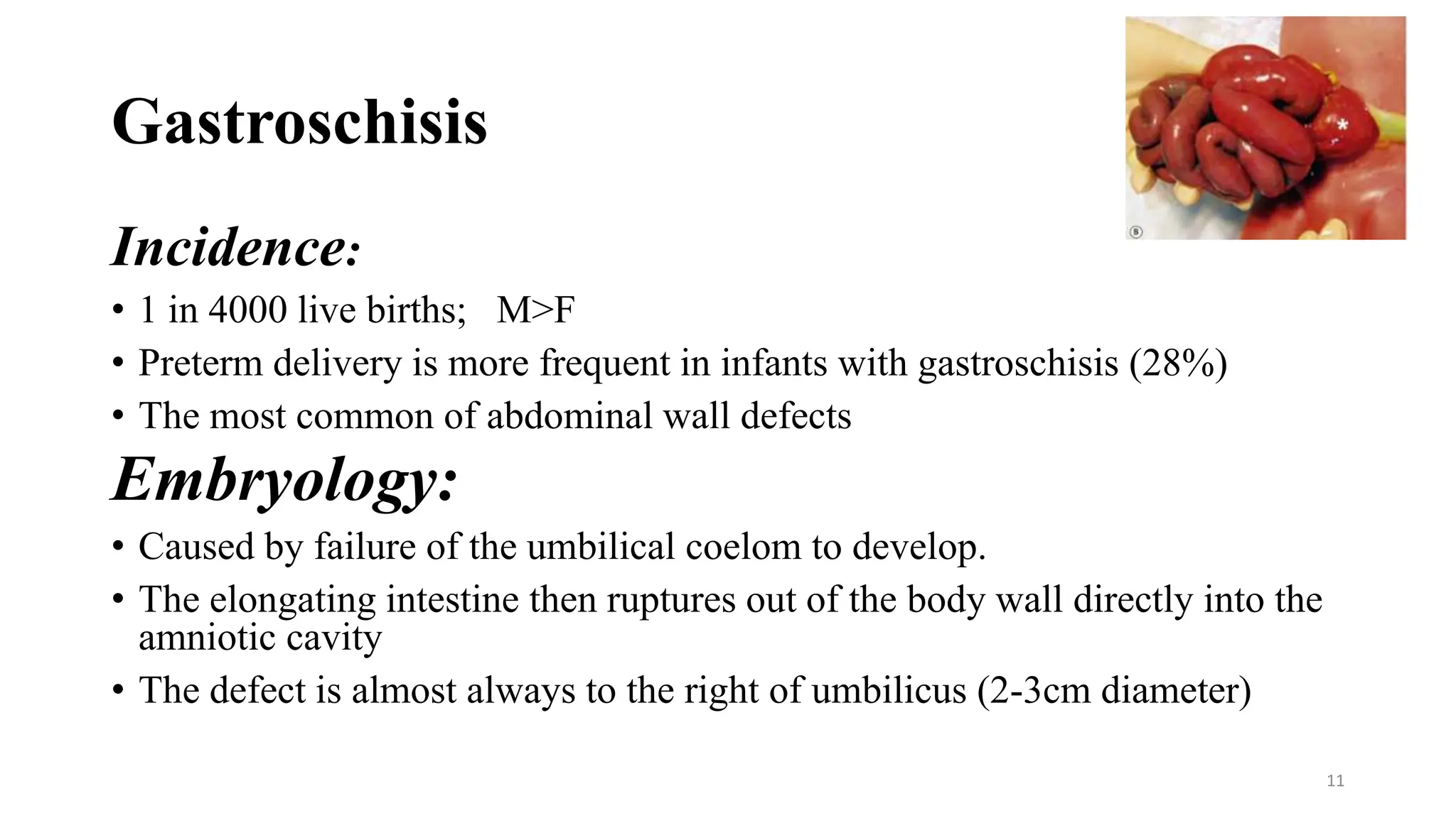 Approach to Congenital abdominal wall defects .pptx