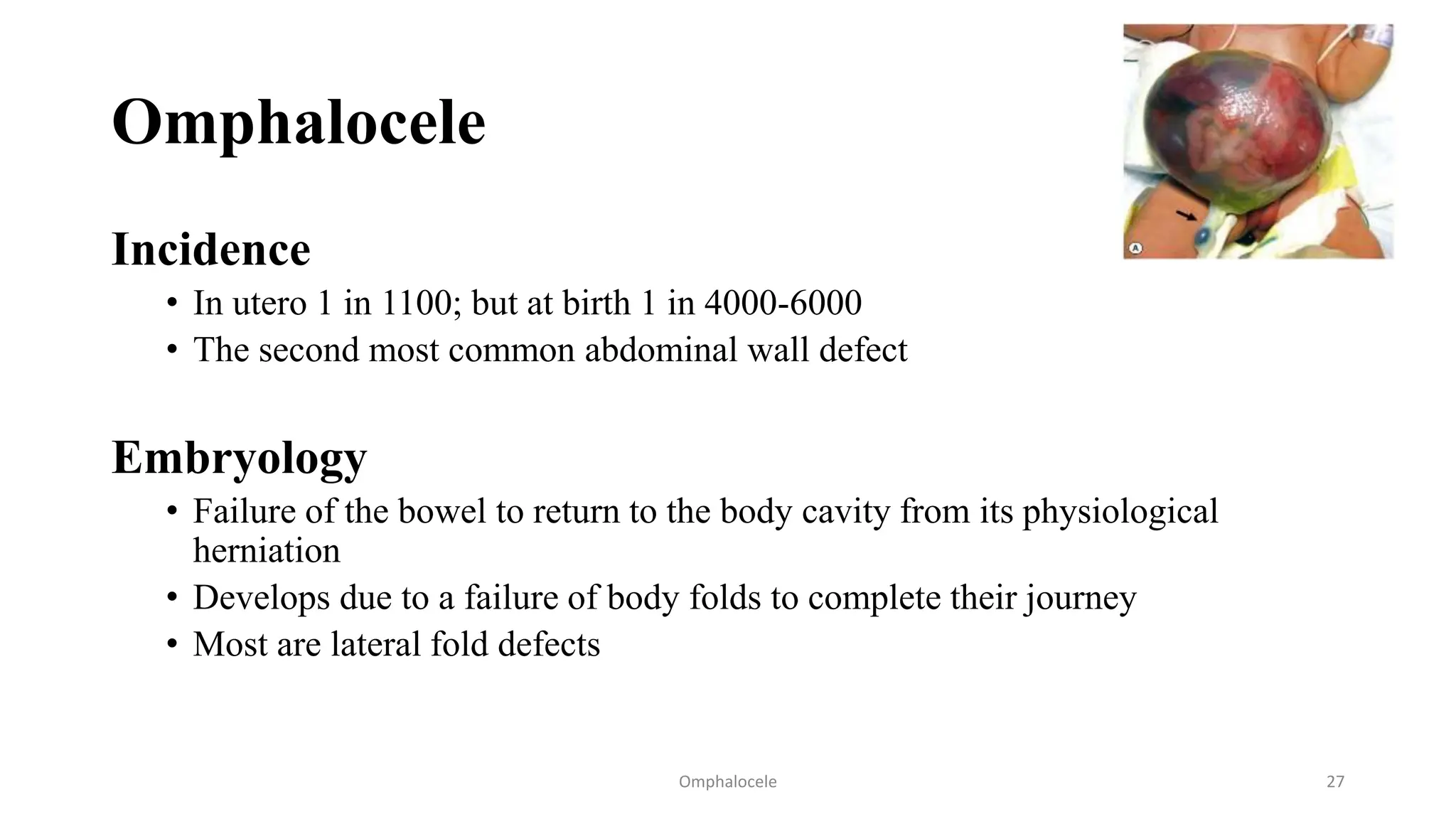 Approach to Congenital abdominal wall defects .pptx