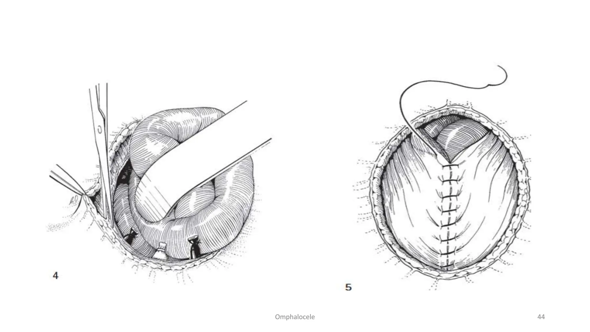 Approach to Congenital abdominal wall defects .pptx