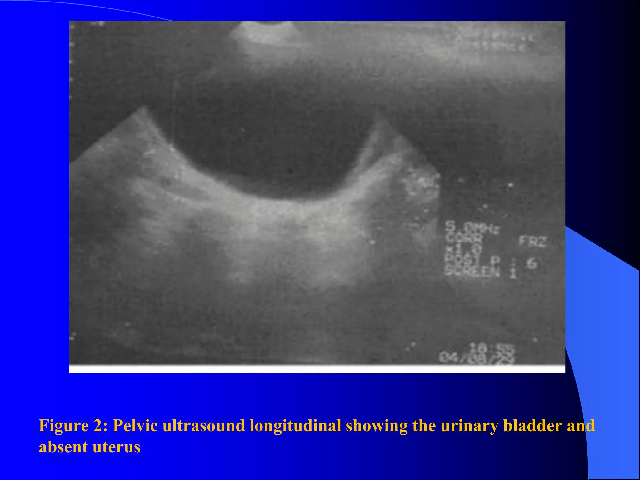 Congenital abnormaleties of the uterus | PPTX