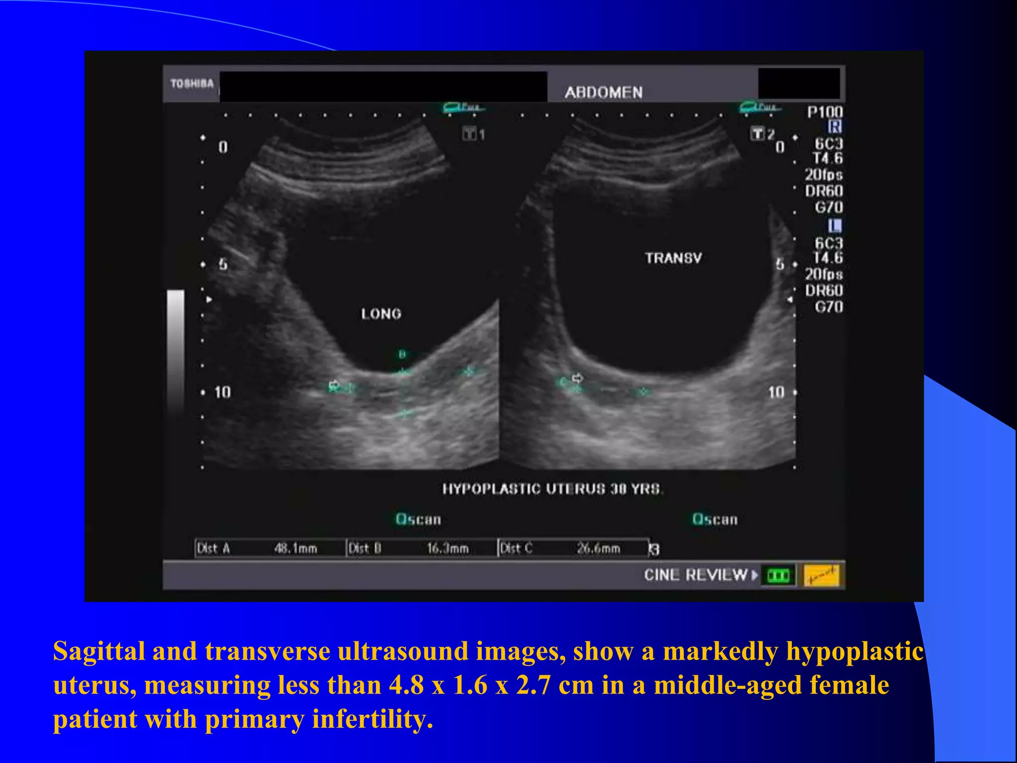 Congenital abnormaleties of the uterus | PPTX