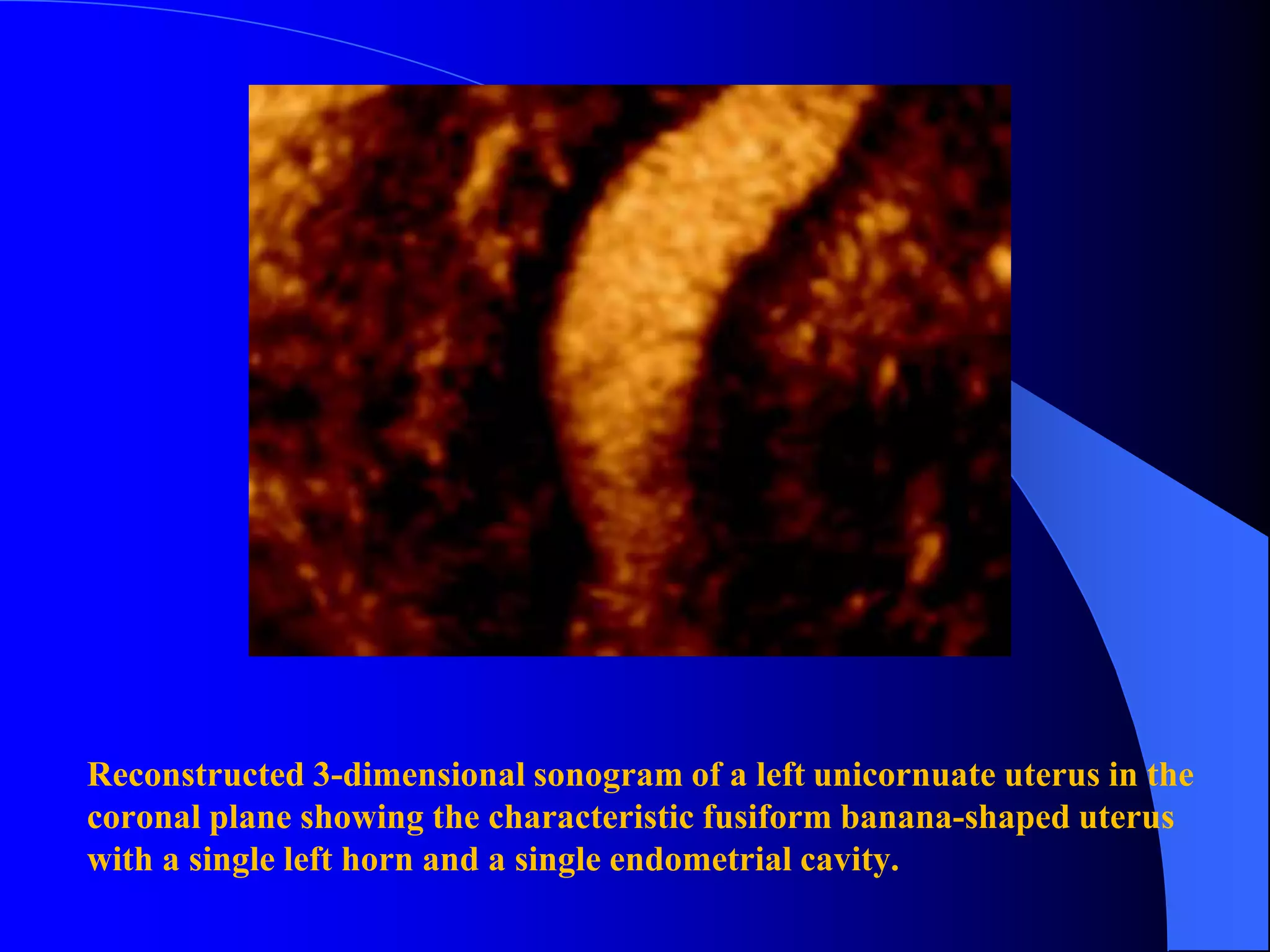 Congenital abnormaleties of the uterus | PPTX