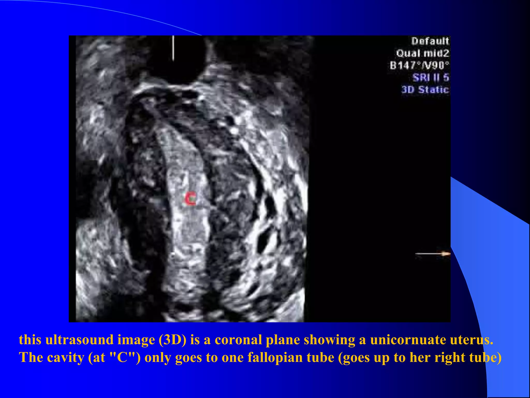 Congenital abnormaleties of the uterus | PPTX