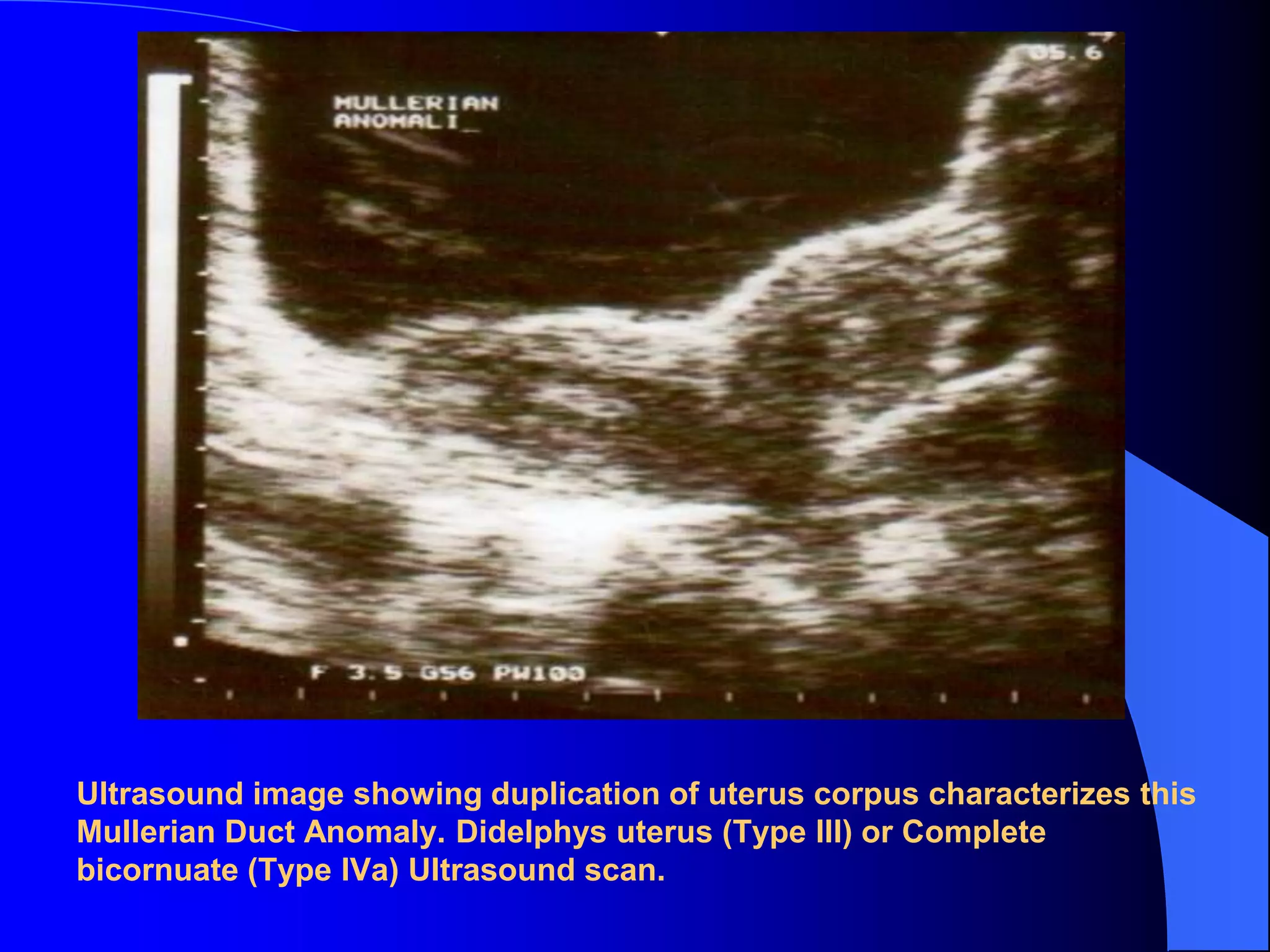 Congenital abnormaleties of the uterus | PPTX