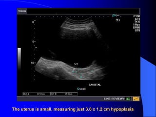 Congenital abnormaleties of the uterus | PPTX