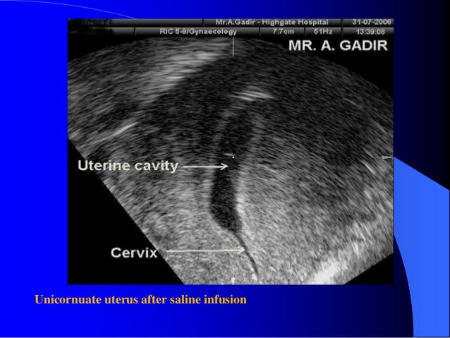 Congenital abnormaleties of the uterus