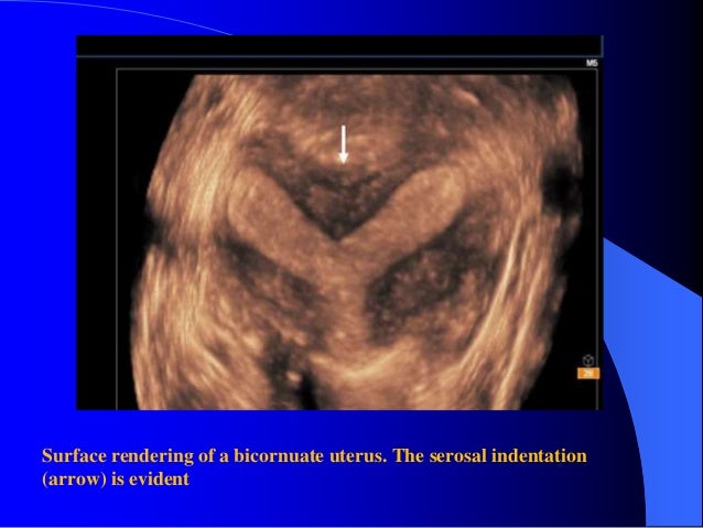 Uterus Didelphys Image Radiopaediaorg