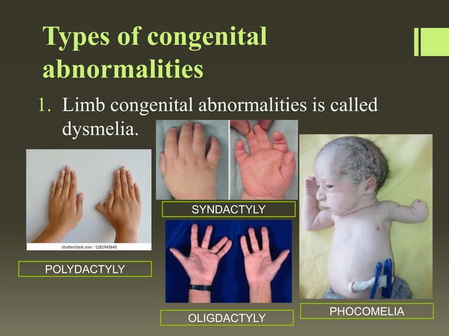 Congenital Abnormalities | PPTX