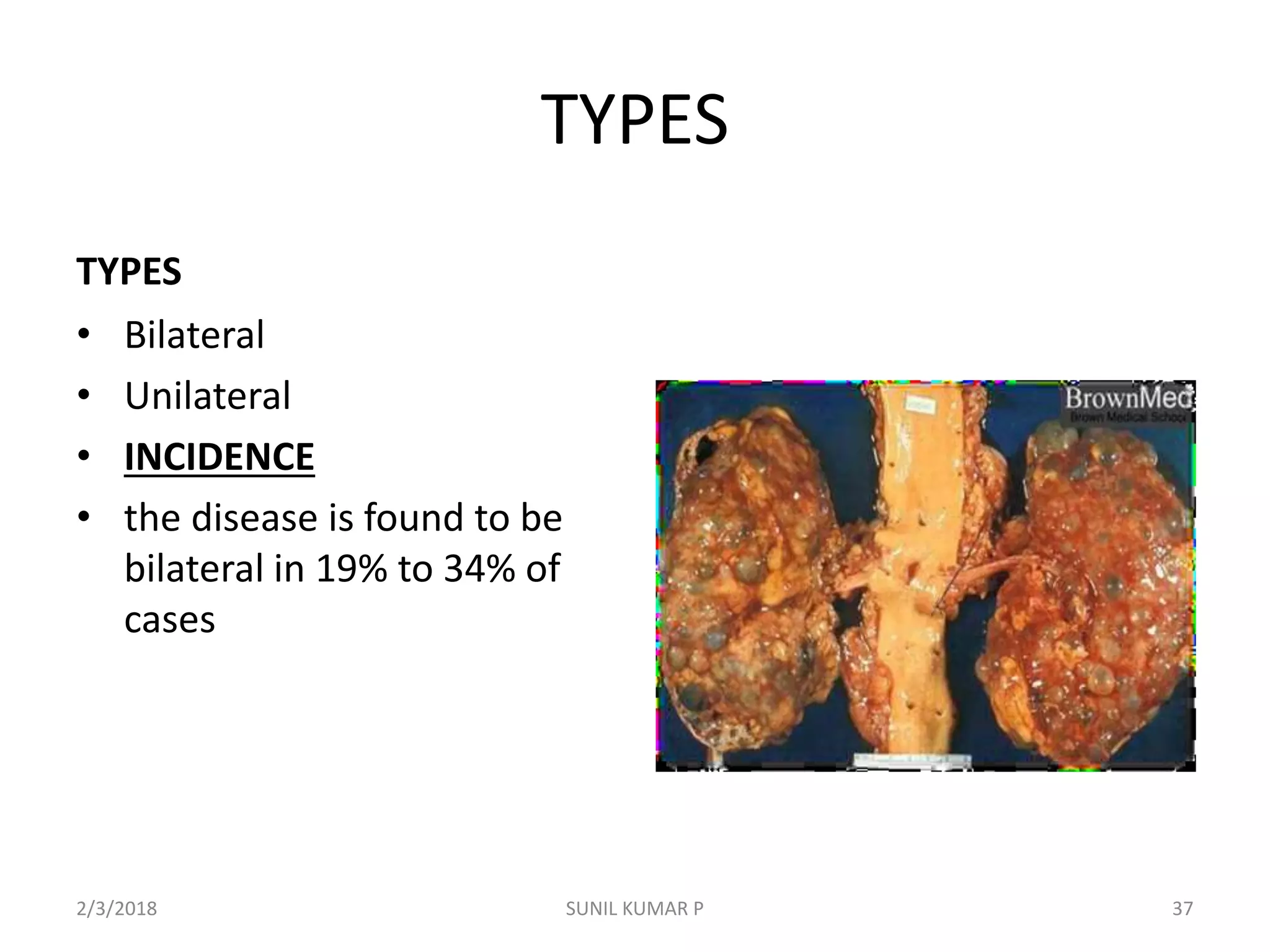 Congenital abnormalities of kidney and urinary system | PPTX