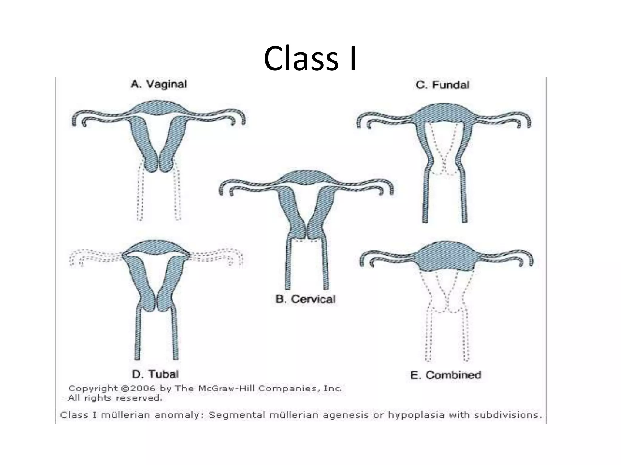 Congenital abnormalities of reproductive system | PPTX