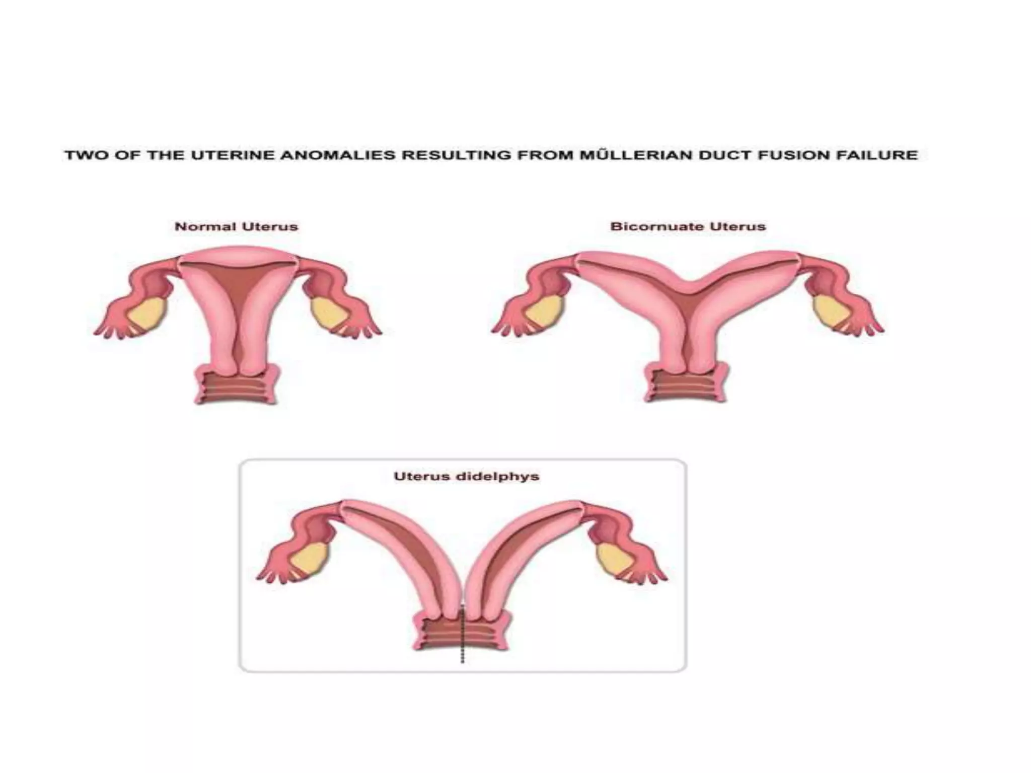 Congenital abnormalities of reproductive system | PPTX