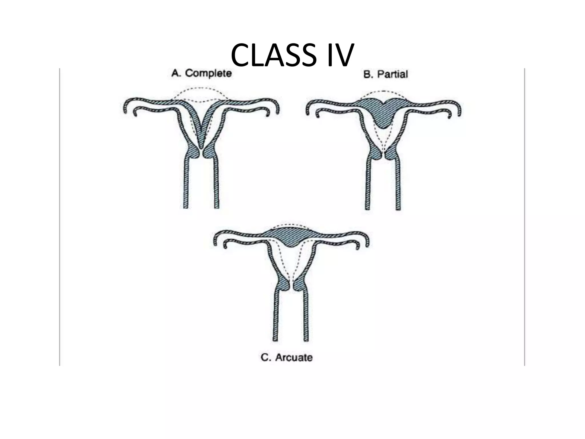 Congenital abnormalities of reproductive system | PPTX