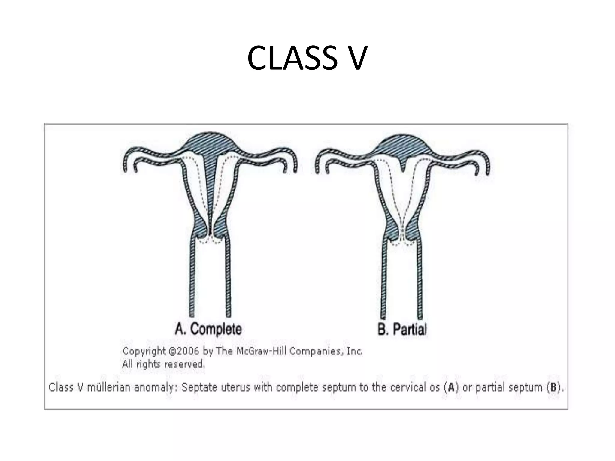 Congenital abnormalities of reproductive system | PPTX