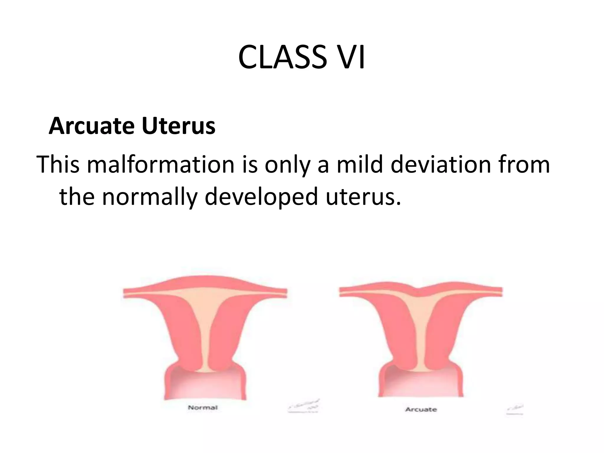 Congenital abnormalities of reproductive system | PPTX