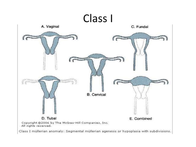 Congenital abnormalities of reproductive system | PPTX | Pregnancy ...