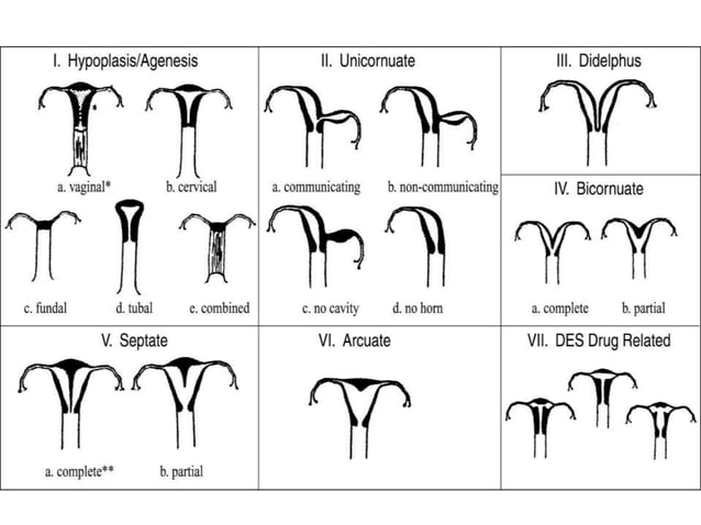 Congenital abnormalities of reproductive system | PPTX | Pregnancy ...