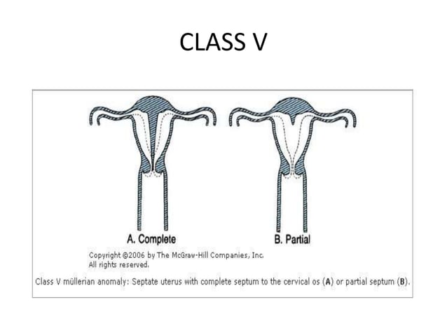 Congenital abnormalities of reproductive system | PPTX | Pregnancy ...