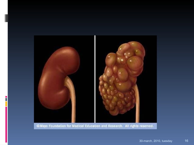 Congenital abnormities of kidney ad ureter 30 3-10 | PPT | Reproductive ...