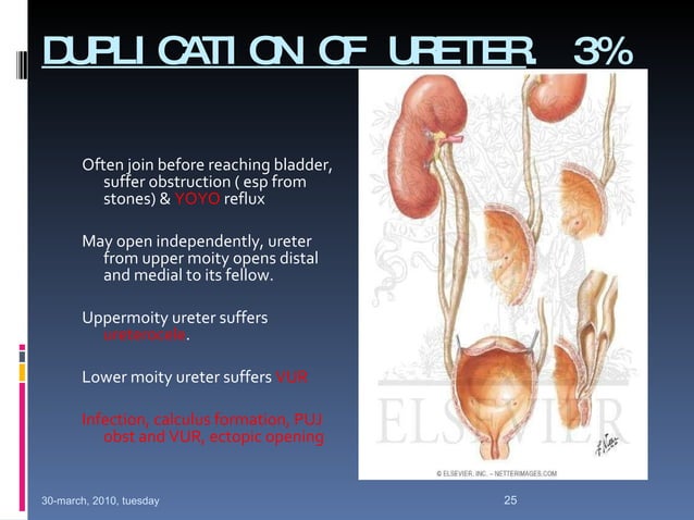 Congenital abnormities of kidney ad ureter 30 3-10 | PPT | Reproductive ...