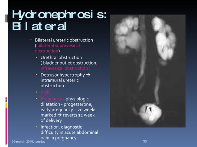Congenital abnormities of kidney ad ureter 30 3-10 | PPT | Reproductive ...