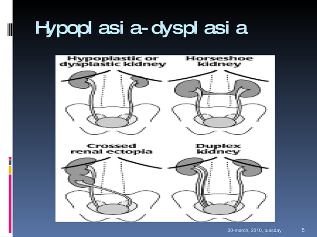 Congenital abnormities of kidney ad ureter 30 3-10 | PPT | Reproductive ...