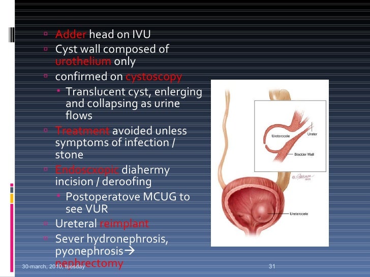Ureterocele Adder Head