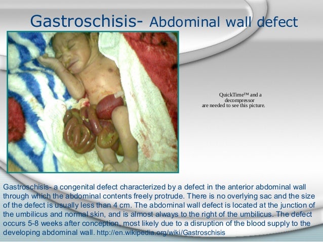 Congenital abomalities