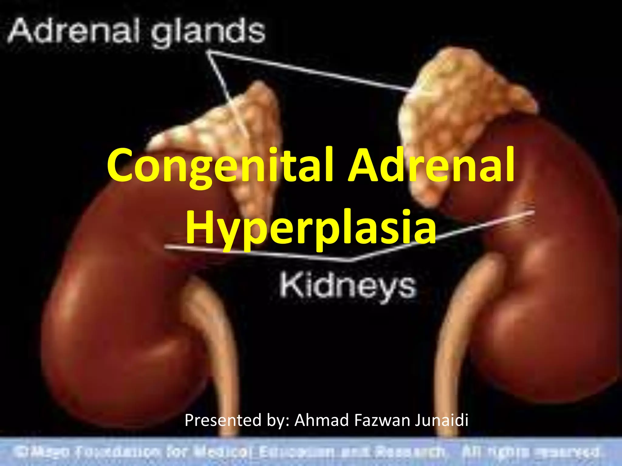 Congenital adrenal hyperplasia | PPTX
