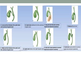 Congenital anamolies and applied anatomy of biliary tree | PPTX